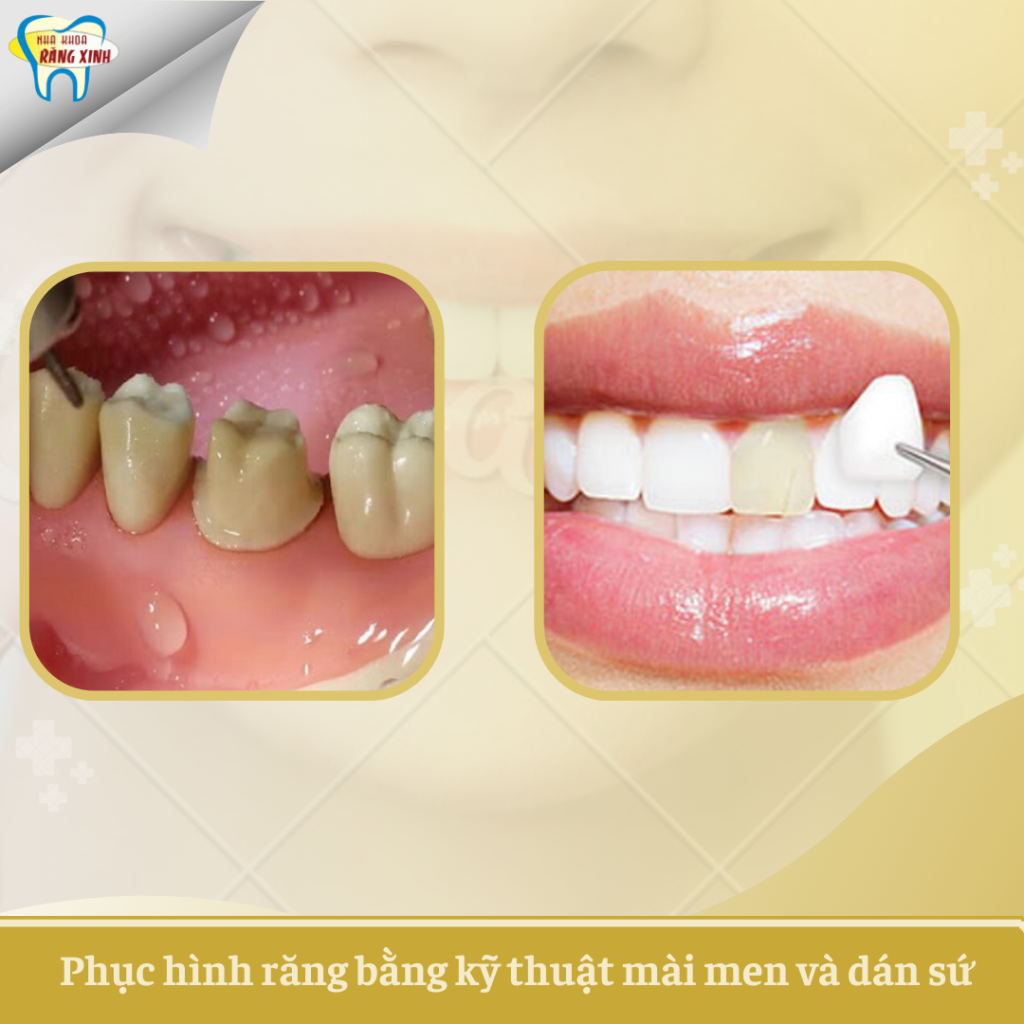 CÁC PHƯƠNG PHÁP PHỤC HÌNH RĂNG. Nha Khoa Răng Xinh